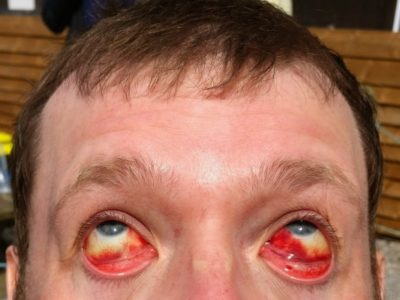 What is Mask Squeeze - And Why Does It Happen? - Go Freediving